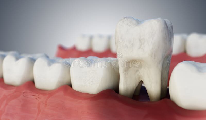 Infected Tooth in Mouth. 3D Rendered Illustration Stock Illustration ...