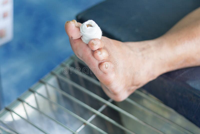 Diabetes foot ulcers stock image. Image of pain, foot - 153789959