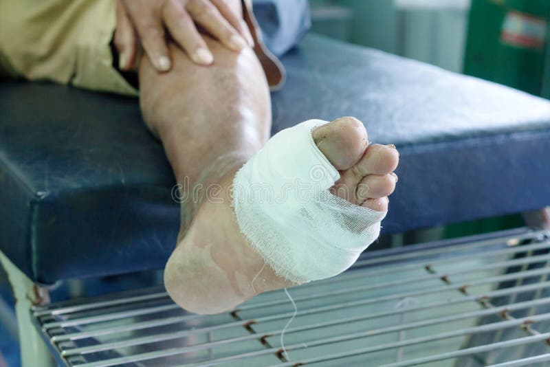 Infected Wound of Diabetic Foot Stock Photo - Image of medical, muscle ...