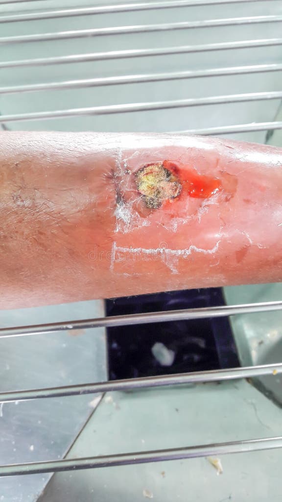 Infected wound of leg stock photo. Image of chronic, ulcer - 75588816