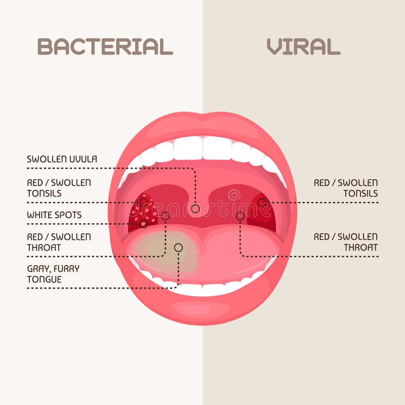 Types D'infections De La Gorge Le Mal De Gorge : Des Causes Multiples