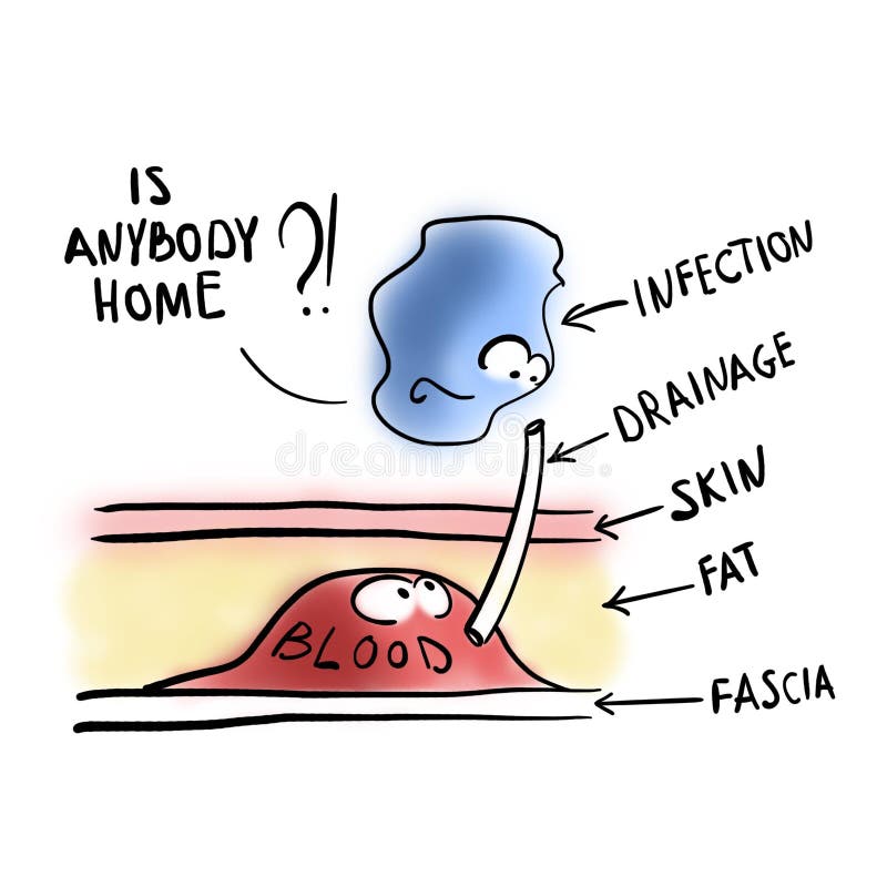 Wound Infection Animation Wound Healing: Over 13,969 Royalty Free