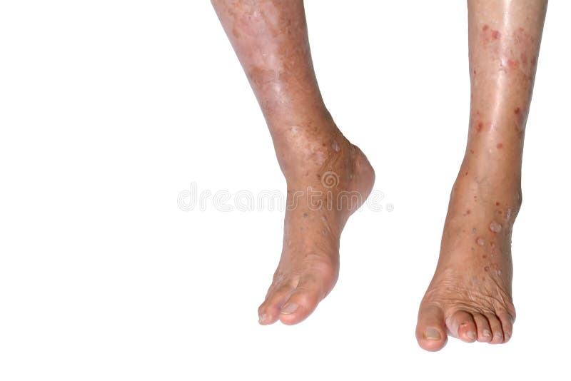 Infection in the leg stock photo. Image of fungal, patient - 87531912