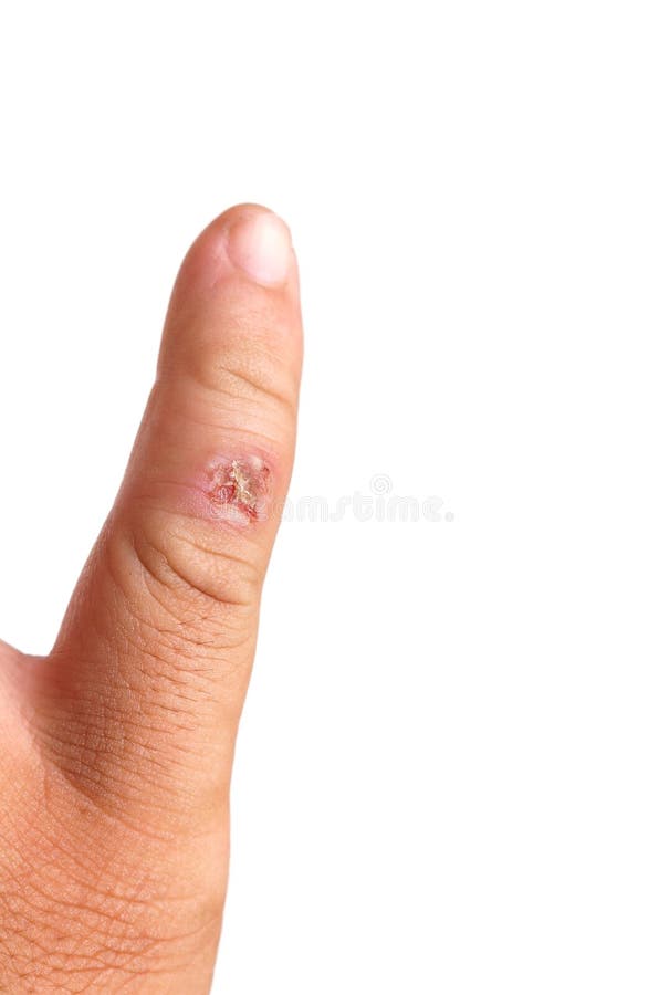 Abscess Wound Stock Photos - Download 115 Royalty Free Photos