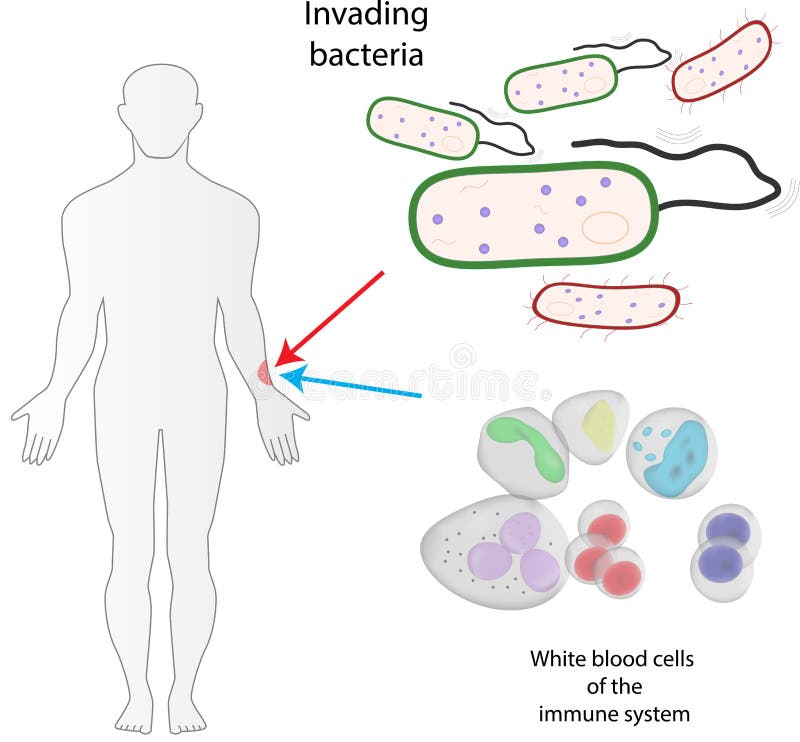 Infezione Illustrazioni, Vettoriali E Clipart Stock – (409,690 ...