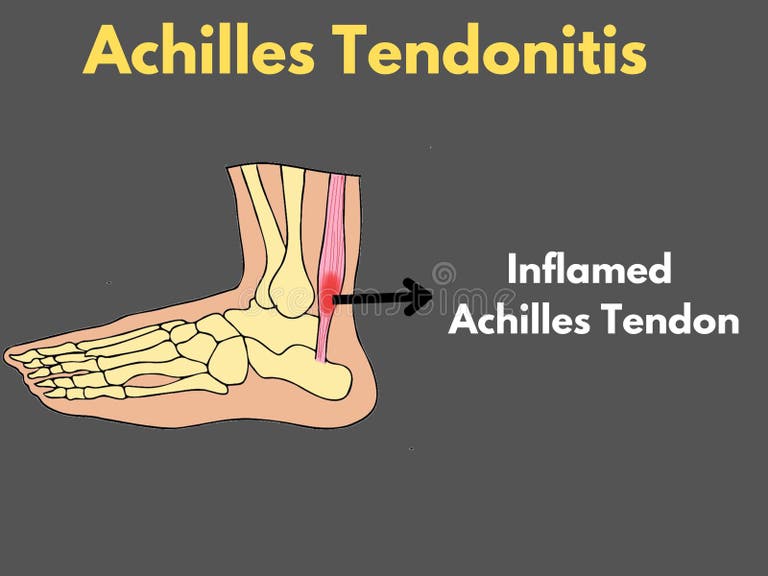 Inflamed Achilles Tendon - 1 Stock Illustration - Illustration of adult ...