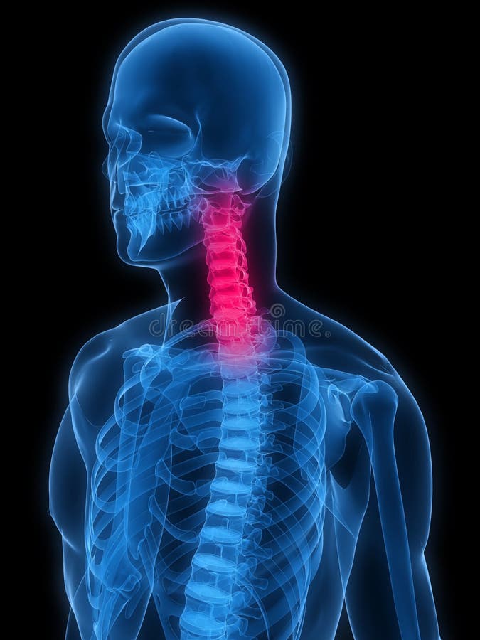 Inflamed neck stock illustration. Illustration of pain - 12989599