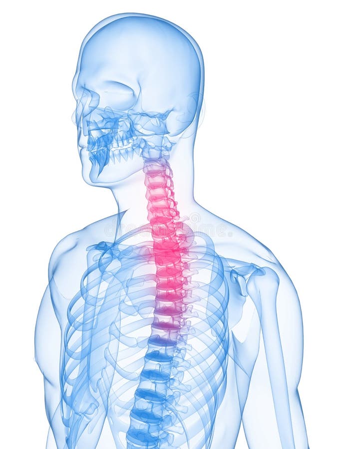 Inflamed neck stock illustration. Illustration of pain - 12989599