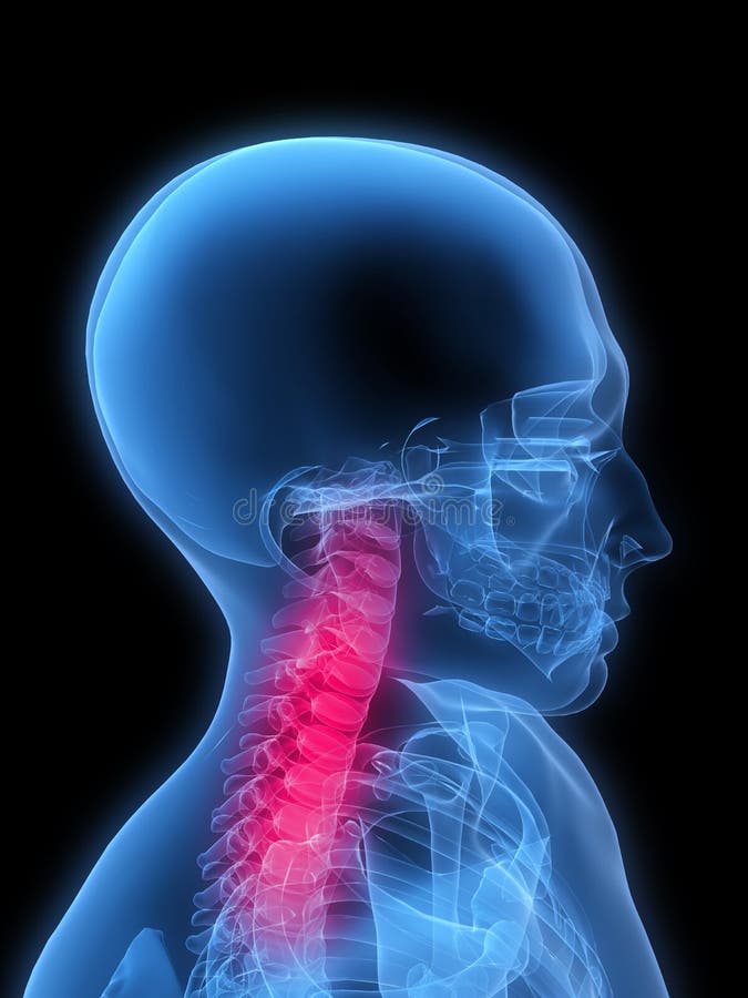 Inflamed neck stock illustration. Illustration of pain - 12989599