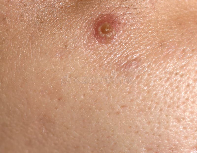 Inflamed Skin. Acne on the Face Stock Image - Image of dermis ...