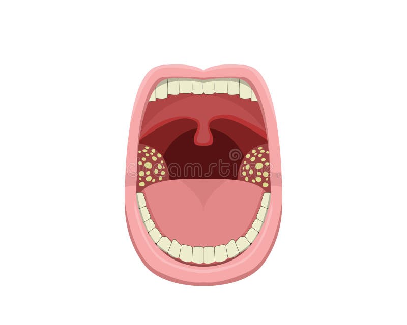 Inflamed Tonsillitis in Vector Design Stock Vector - Illustration of ...