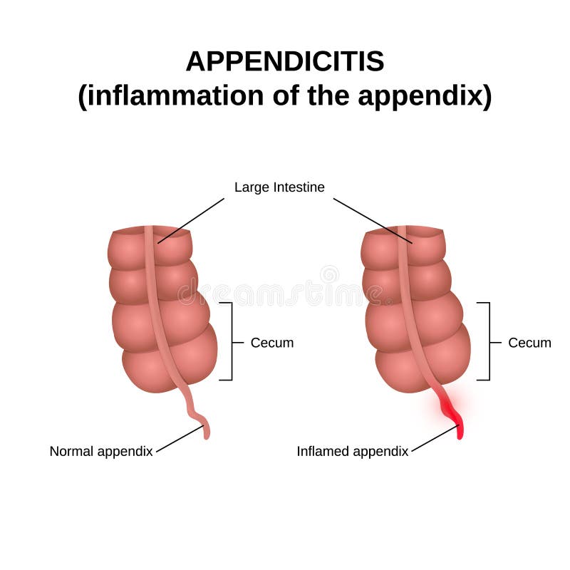 Inflammation Of The Appendix Stock Vector Illustration Of Abdominal