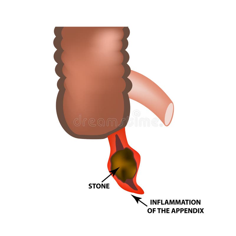 Appendicitis Inflammation Of The Appendix Colon Stock Vector Illustration Of Care Human