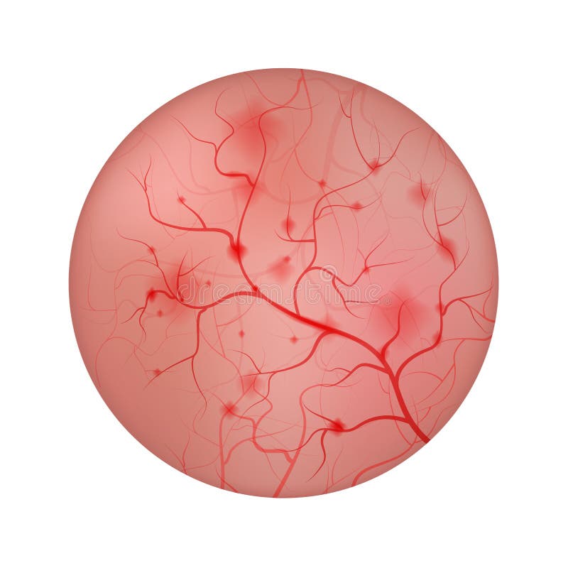 Cystit. Inflammation I Blåsan. Njurarnas Och Urinblåsans Struktur ...