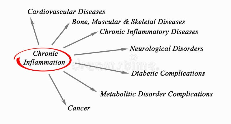 Inflammation Chronique illustration stock. Illustration du musculaire ...
