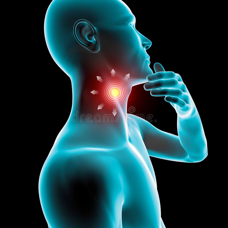 Inflammation D'angine, Rougeur, Douleur, Illustration Stock ...