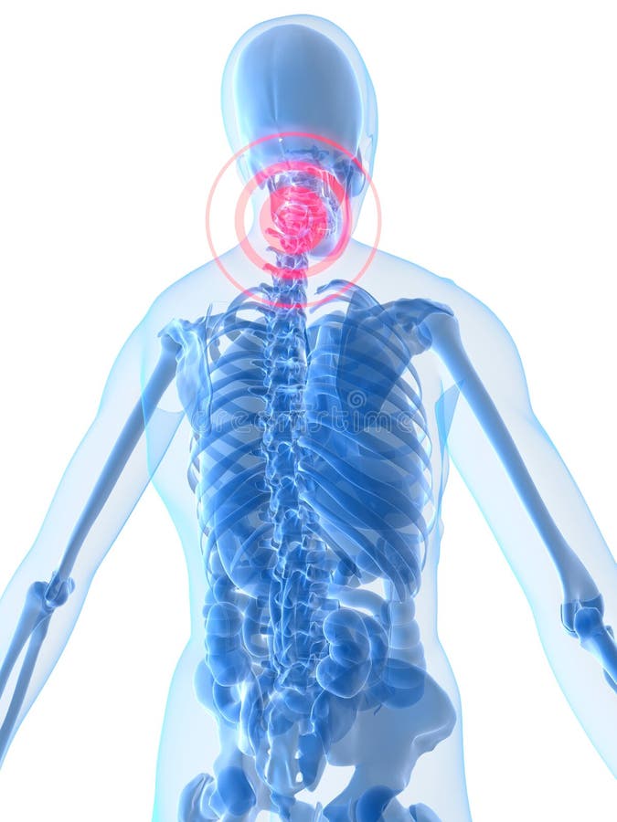 Inflammation de cou illustration stock. Illustration du ostéoporose ...