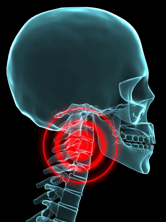 Inflammation de cou illustration stock. Illustration du ostéoporose ...