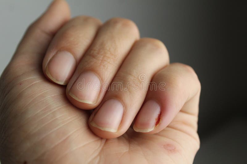 Inflammation on the Finger of the Little Finger. Skin Diseases Stock ...