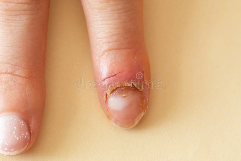 Inflammation of the Finger. Managing Finger Inflammation. Stock Image ...
