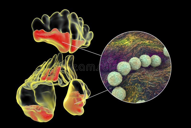 Inflammation of Frontal and Maxillary Sinuses and Close-up View of ...