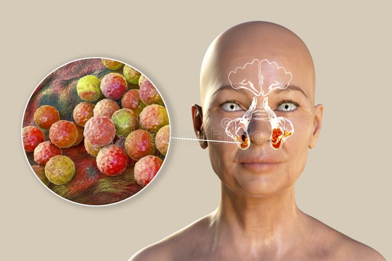 Inflammation of Frontal Sinuses and Close-up View of Staphylococcal ...