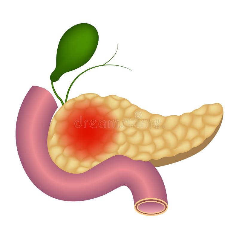 Inflammation of the Human Pancreas. Stock Vector - Illustration of ...