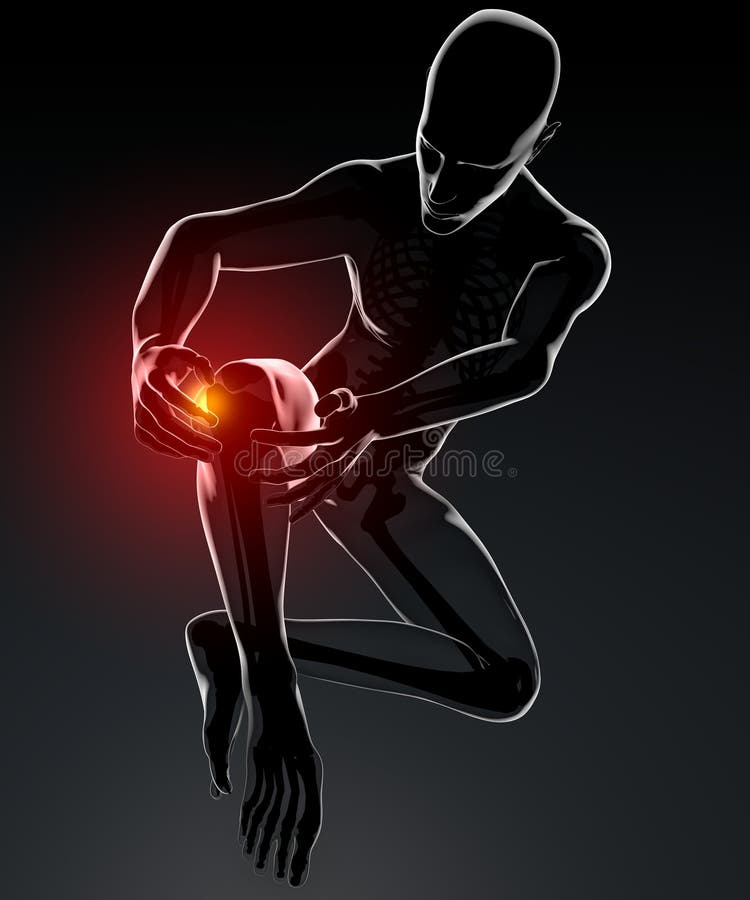 Inflammation of Knee Pain Skeleton X-ray Stock Illustration ...