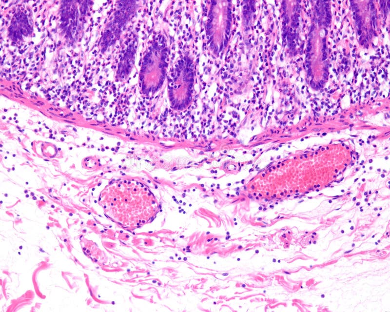 Inflammation. Leucocyte Diapedesis Stock Image - Image of diapedesis ...