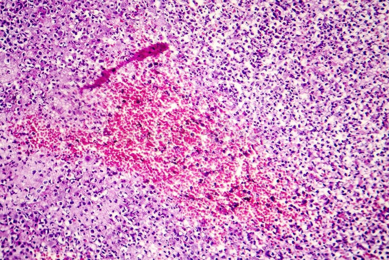 Inflammation, Light Micrograph Showing Different Inflammatory Cells ...