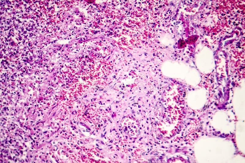 Inflammation, Light Micrograph Showing Different Inflammatory Cells ...
