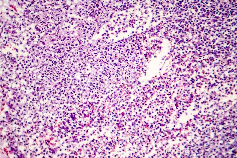 Inflammation, Light Micrograph Showing Different Inflammatory Cells ...