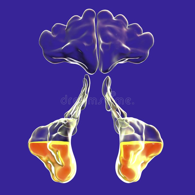 Inflammation of Maxillary Cavity, or Antrum of Highmore Stock ...