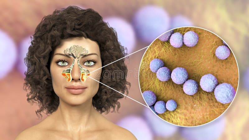 Inflammation of Maxillary Sinuses and Close-up View of Streptococci ...