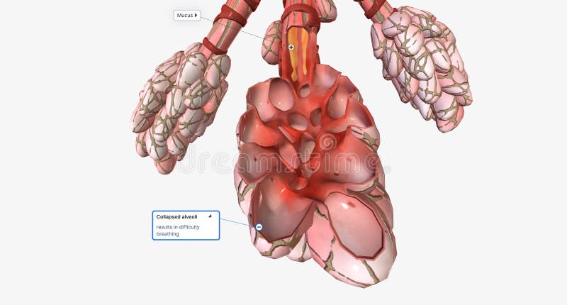Bronchial Airways Stock Illustrations – 196 Bronchial Airways Stock ...