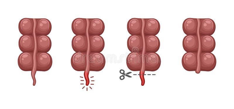 Inflamed Appendicitis Stock Illustrations – 59 Inflamed Appendicitis ...
