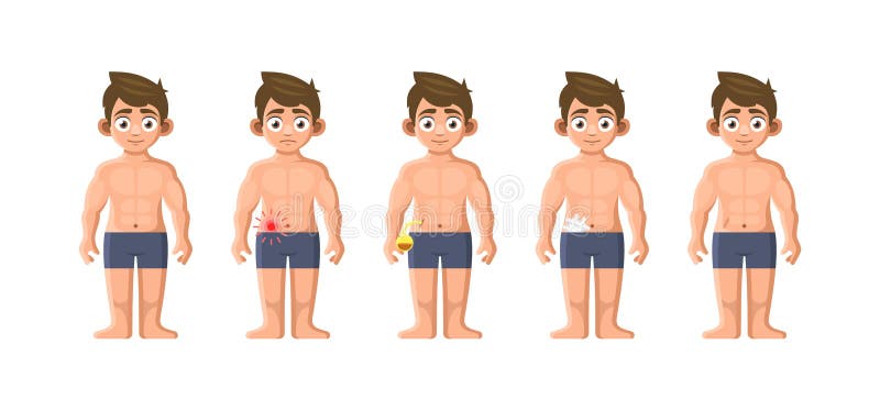 Inflammation of the Appendix. Stock Vector - Illustration of diagram ...