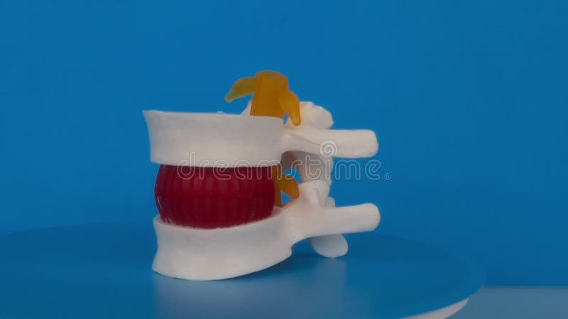 Inflammation and Soreness of Herniated Discs and Other Displaced Joints ...