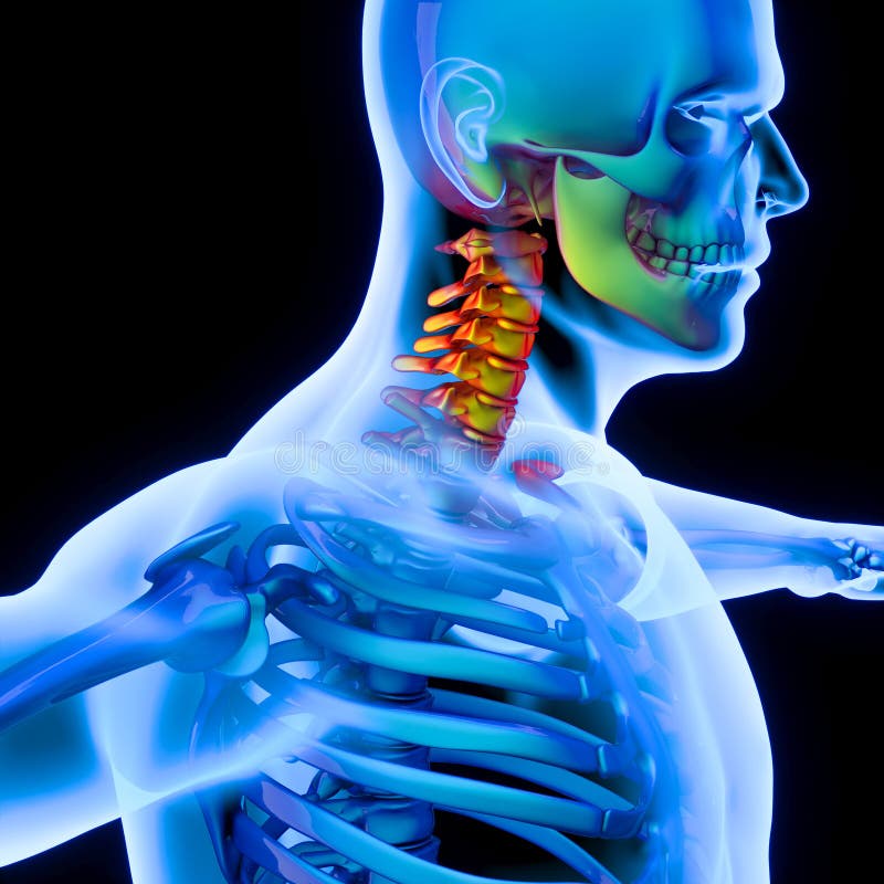 Inflammation of the Spine To the Cervical Vertebrae Stock Illustration ...