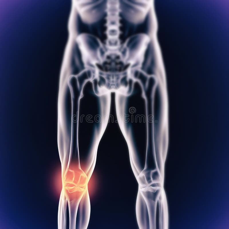 When Inflammation Strikes. a Cgi View of an Inflamed Joint on Blue ...