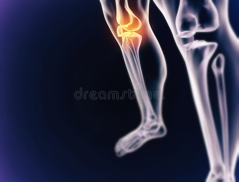 When Inflammation Strikes. a Cgi View of an Inflamed Joint Isolated on ...