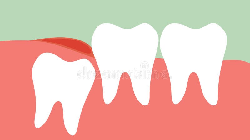 Inflammation of Wisdom Tooth Angular or Mesial Impaction Stock Footage ...