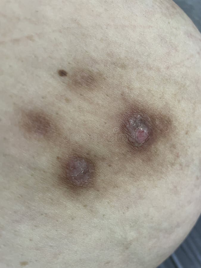 Inflammatory Changes Pustules, Rash on the Skin Stock Image - Image of ...