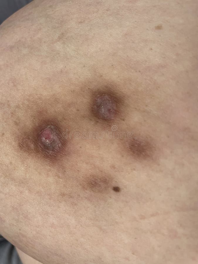 Inflammatory Changes Pustules, Rash on the Skin Stock Photo - Image of ...
