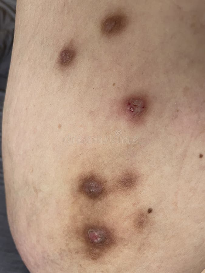 Inflammatory Changes Pustules, Rash on the Skin Stock Image - Image of ...