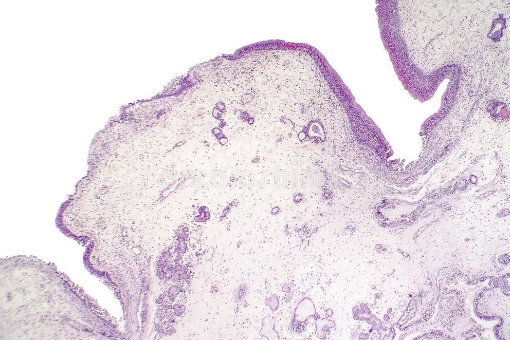 Inflammatory Polyp, Light Micrograph Stock Photo - Image of hematoxylin ...