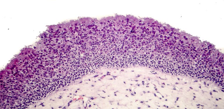 Inflammatory Polyp, Light Micrograph Stock Photo - Image of ...