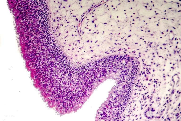 Inflammatory Polyp, Light Micrograph Stock Image - Image of ...