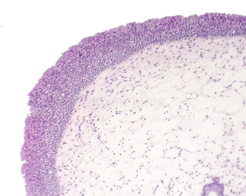 Inflammatory Polyp, Light Micrograph Stock Photo - Image of ...