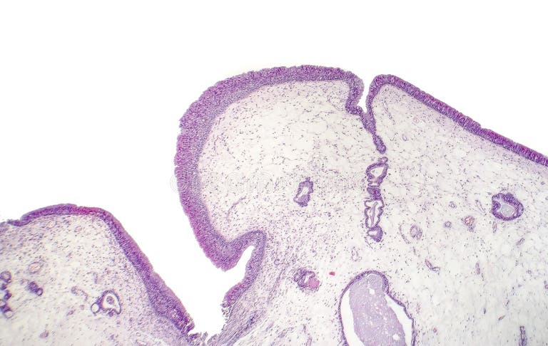 Inflammatory Polyp, Light Micrograph Stock Photo - Image of ...